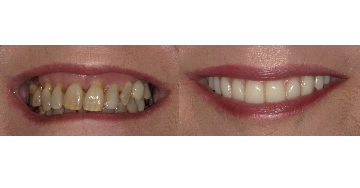 Angela Wanted a Smile Transformation to Feel Confident with Her Teeth ...